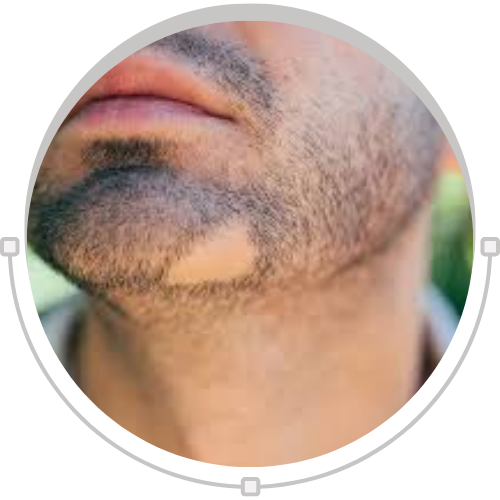 How to Fix a Patchy Beard and Grow a Full Beard Naturally – Opecia